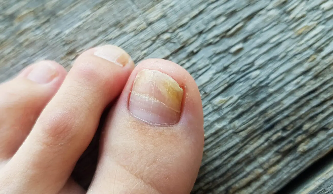 Nagelpilz Symptome Erkennen Effektiv Behandeln Nagelpilz Symptome Erkennen Effektiv Behandeln